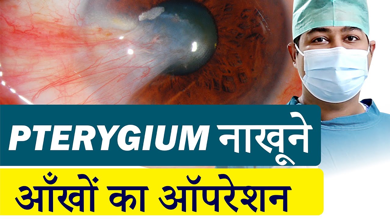 आंखो मे नखूना (Pterygium) का ऑपरेशन | Pterygium Treatment | Best Cornea ...