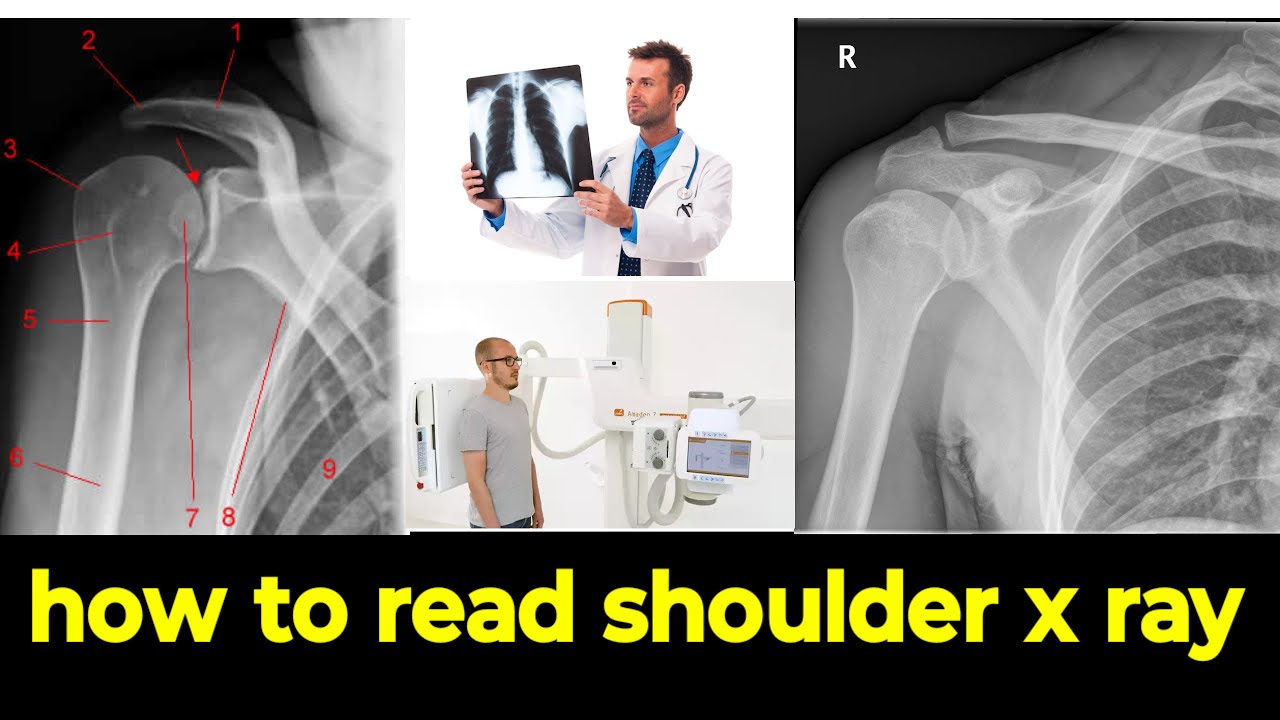 How to read shoulder joint x ray ? शोल्डर ज्वाइंट को एक्सरे में कैसे ...
