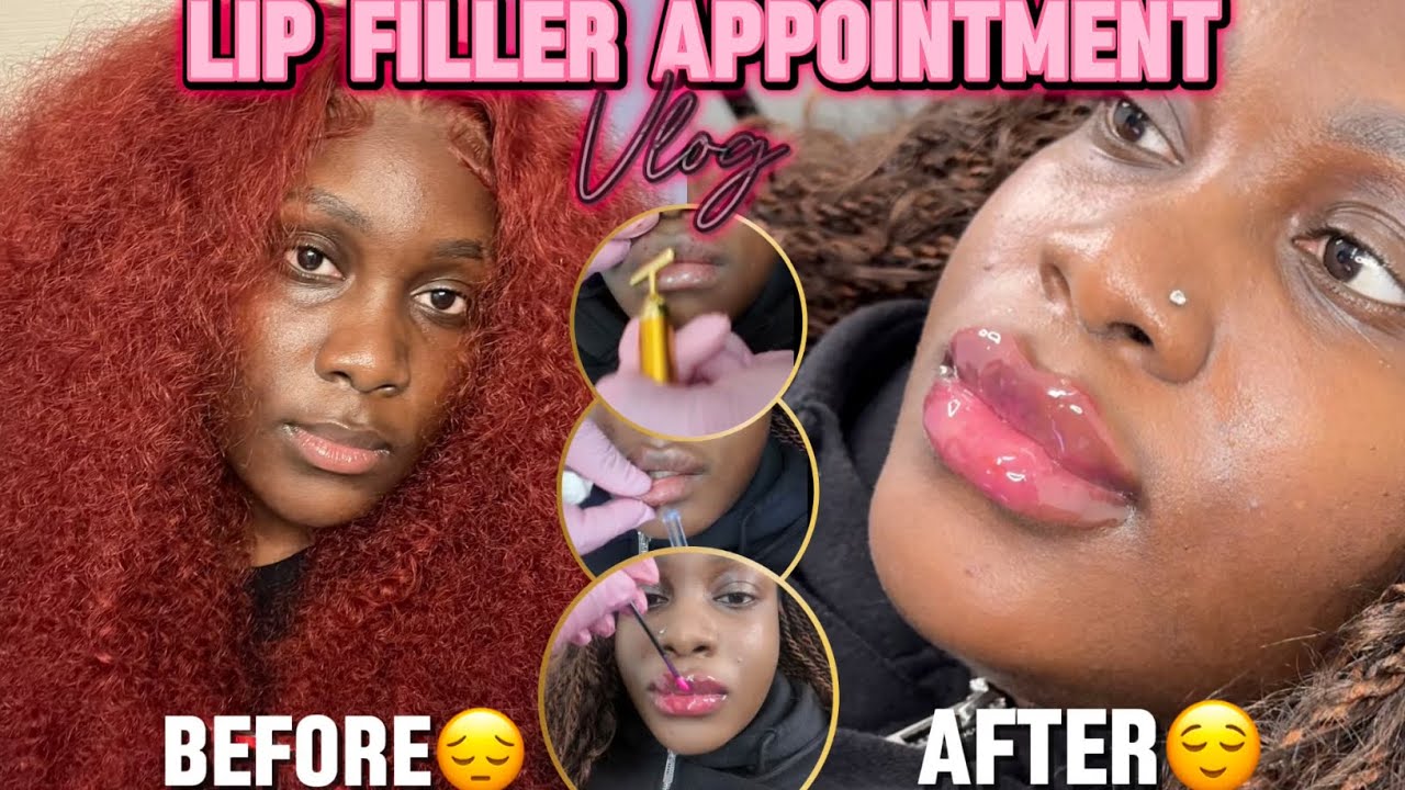 LIP FILLER VLOG ON BLACK GIRL/WOMAN 🫦💉 + RAW & UNCUT (FULL EXPERIENCE ...