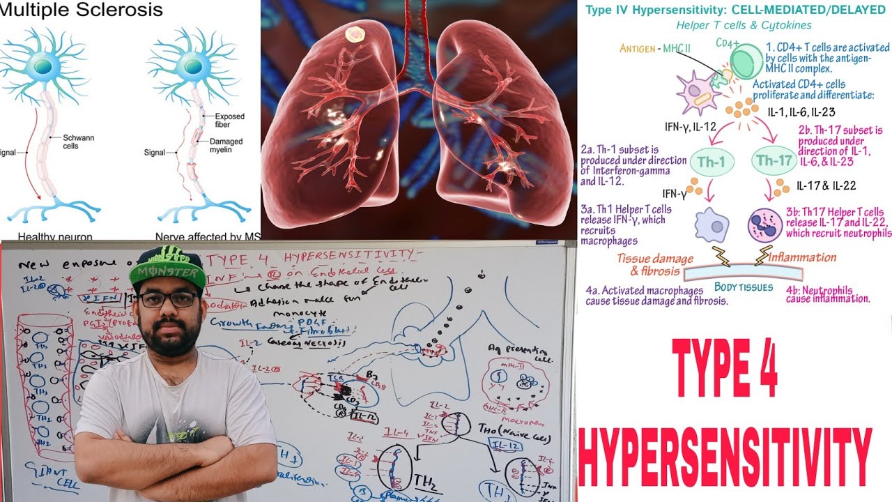 TYPE 4 HYPERSENSITIVITY REACTION | PATHOGENESIS |#immunology # ...