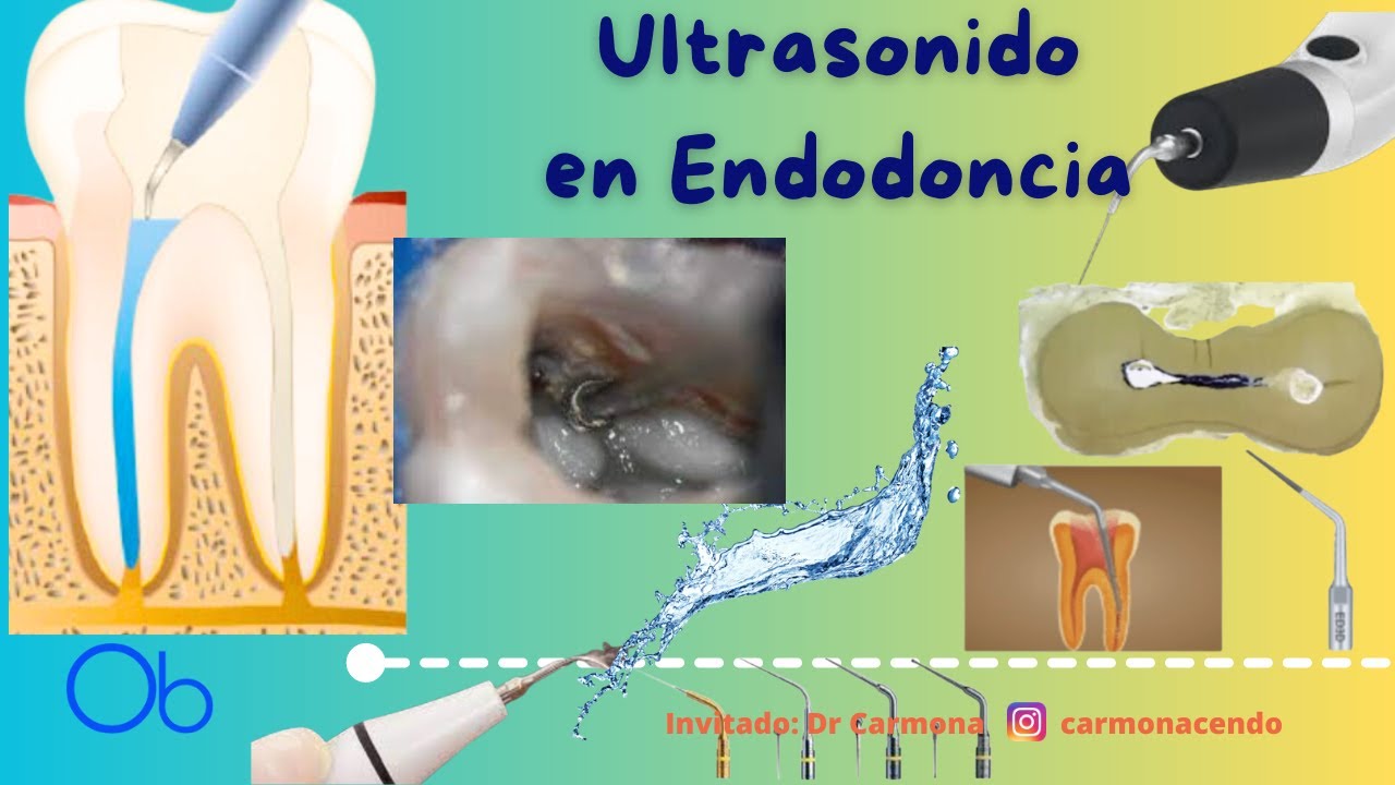 Ultrasonido en Endodoncia - YouTube