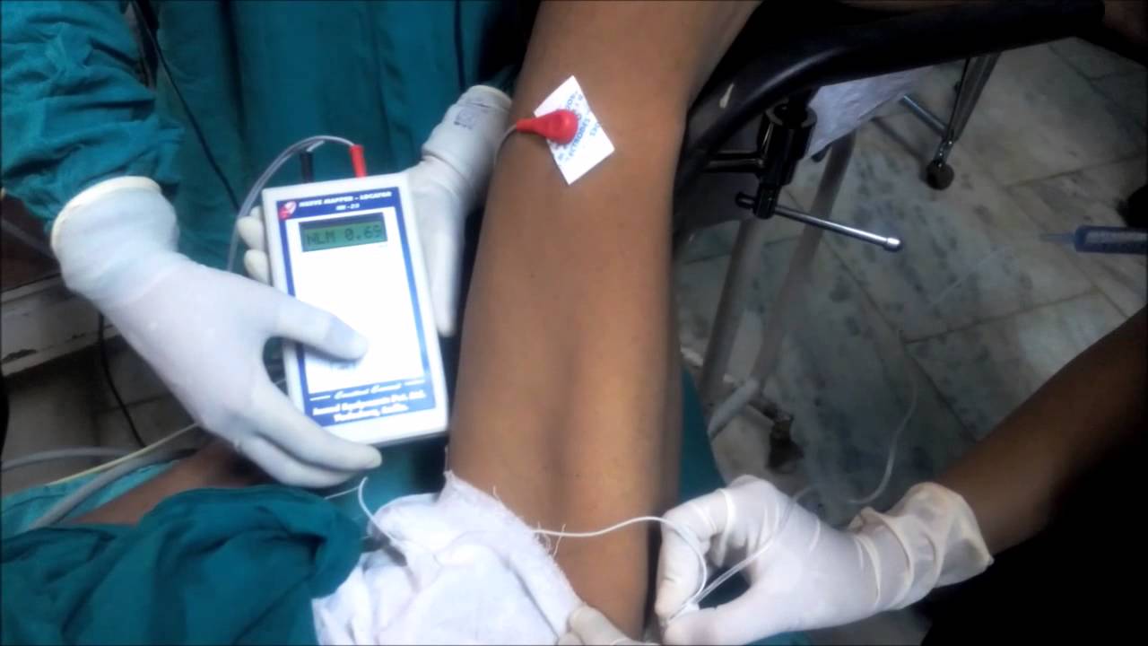 pns guided obturator block in lithotomy position - YouTube