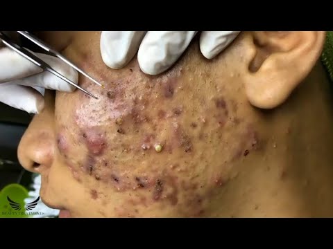 Blackhead Removal - Acne Cystic Treatment - Facial Spa Pimple Popping ...