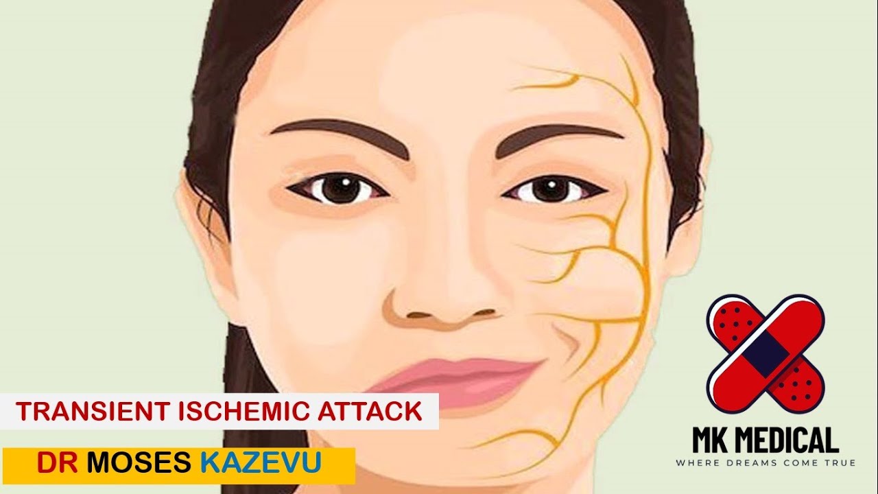 Transient Ischemic attacks || Stroke || Part 4 - YouTube