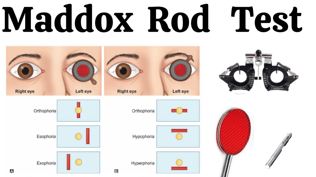 Maddox Rod Test #maddoxrodtest #maddoxrod #heterophoria #phoria # ...
