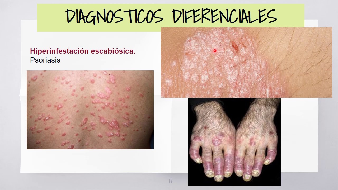 escabiasis parte 2 - YouTube