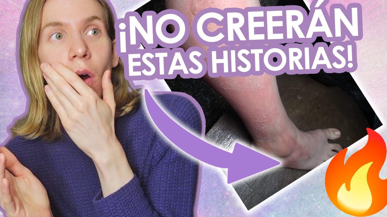 SE DESTRUYÓ LA PIEL COCINANDO- Historias increÍbles de suscriptores 4 ...