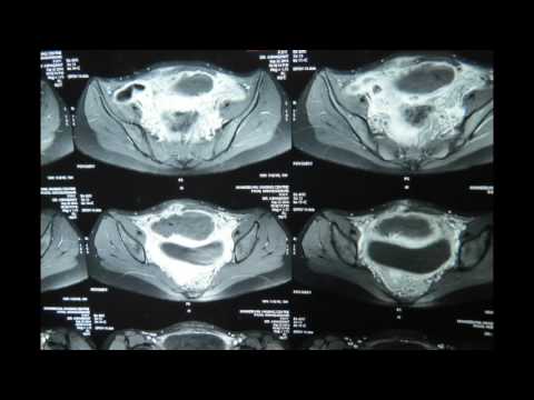 DRAINAGE OF PARIETAL & PELVIC ABSCESS : DR ARUN BHAGWAT - YouTube