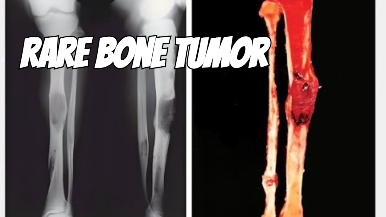 Adamantinoma: The Cancer You Think You've Never Heard Of - YouTube