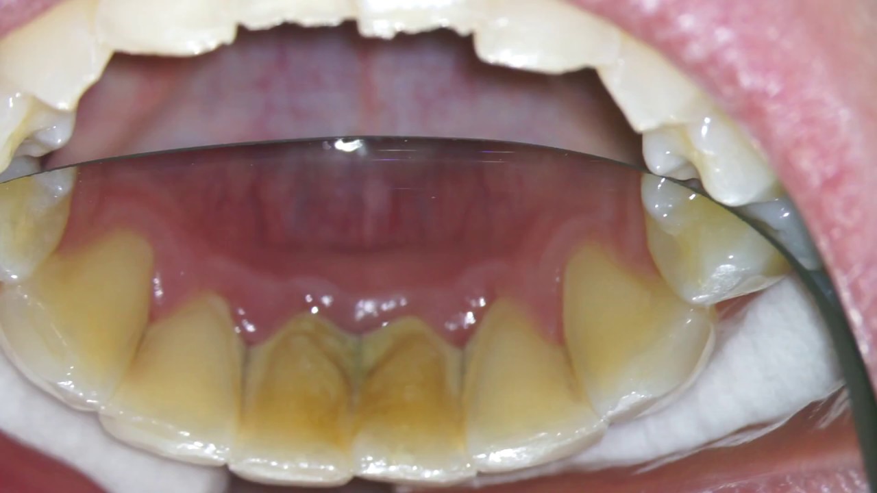 ULTRA SONIC SCALING CALCULUS STONE TARTAR REMOVAL Dental Hygiene - YouTube