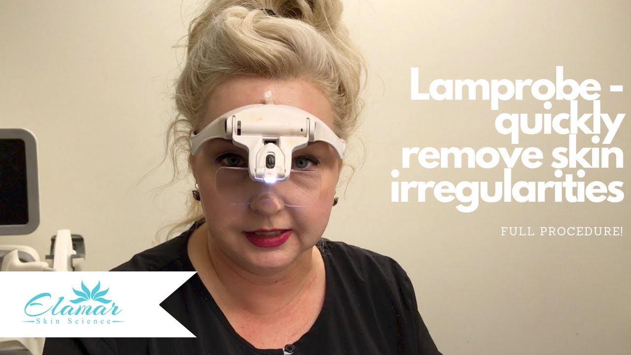 Lamprobe | Quickly and Painlessly Remove Skin Irregularities - YouTube