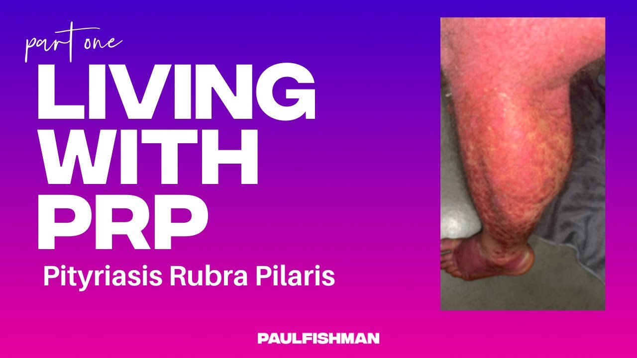 Living with PRP (pityriasis rubra pilaris) - YouTube