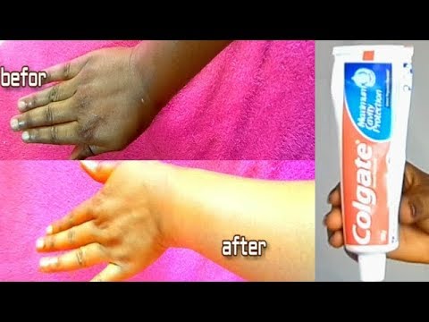 OMG!! I APPLY TOOTHPASTE ON MY SKIN SEE WHAT HAPPEN TO MY SKIN THE ...
