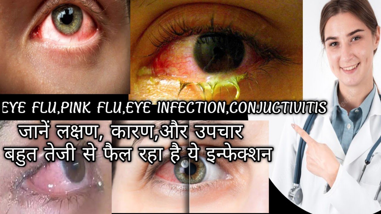 EYE FLU,PINK FLU,CONJUCTIVITIS, SYMPTOMS, TREATMENT।आंखों की इस बीमारी ...