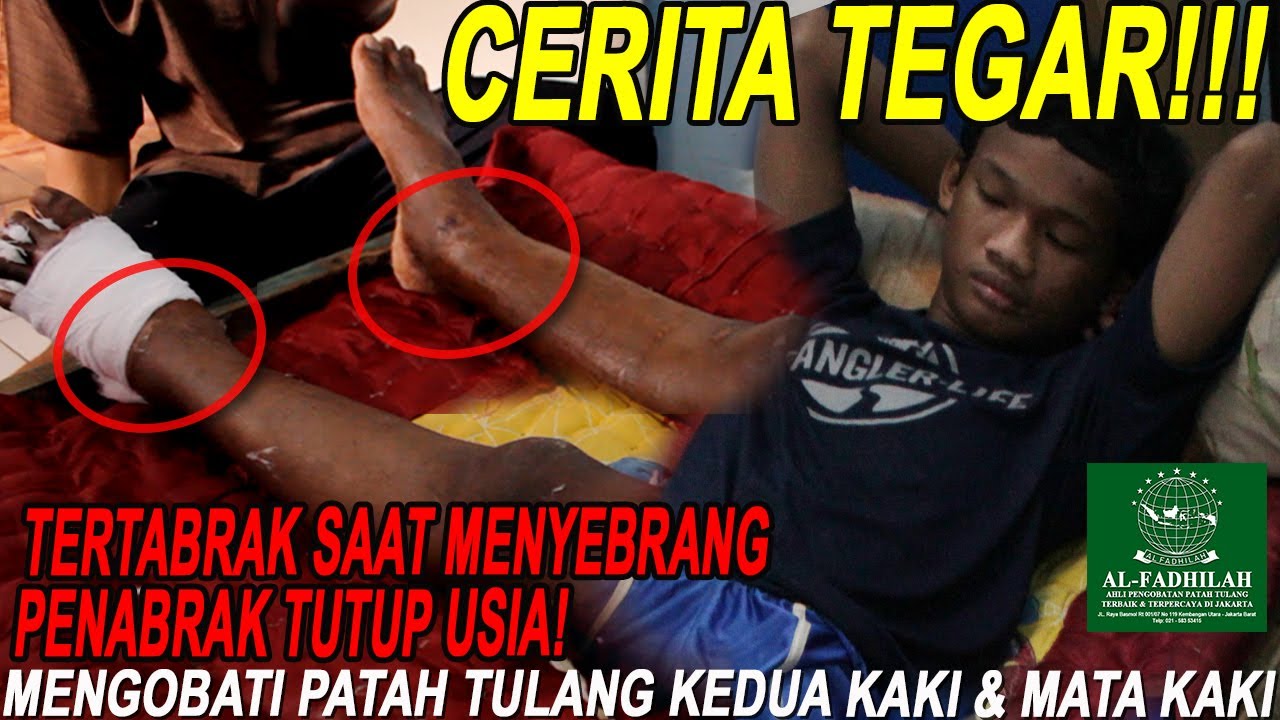 CERITA TEGAR!!! PATAH TULANG KEDUA KAKINYA & MATA KAKI | Pengobatan Al ...