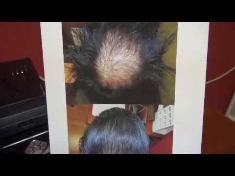 Balding Crown/Vertex Hair Loss Hair Transplant Result Asian Man Dr ...