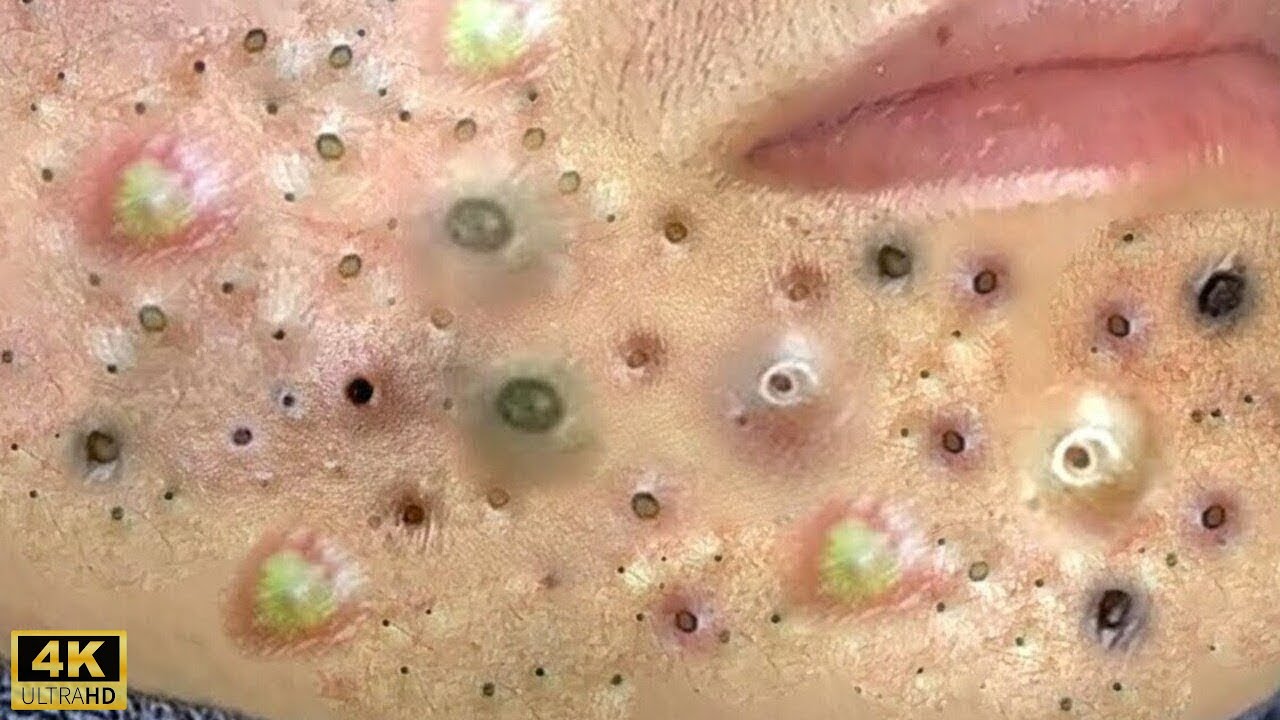 Relaxing and satisfying pimples popping and blackheads removal ...