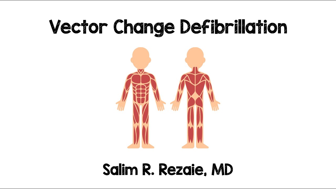 Vector Change Defibrillation - YouTube
