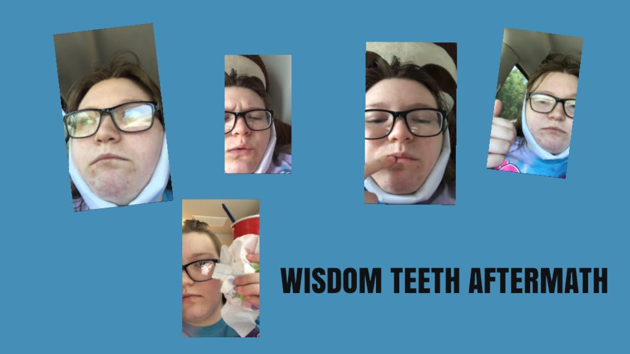 WISDOM TEETH EXTRACTION AFTERMATH | Maelan Dziedzic | 2020 - YouTube
