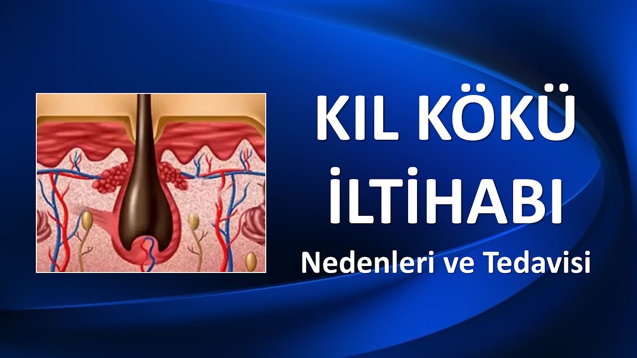 KIL KÖKÜ İLTİHABI Nedenleri ve Tedavisi - YouTube