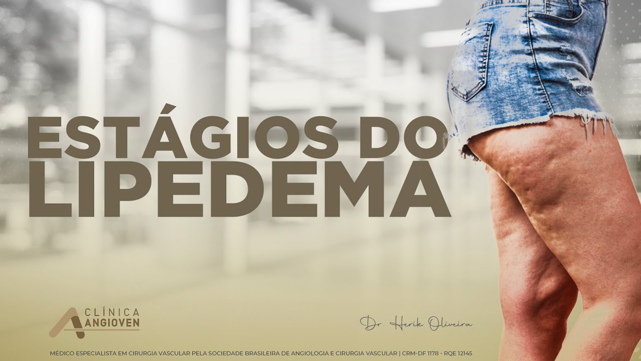Estágios do Lipedema - YouTube