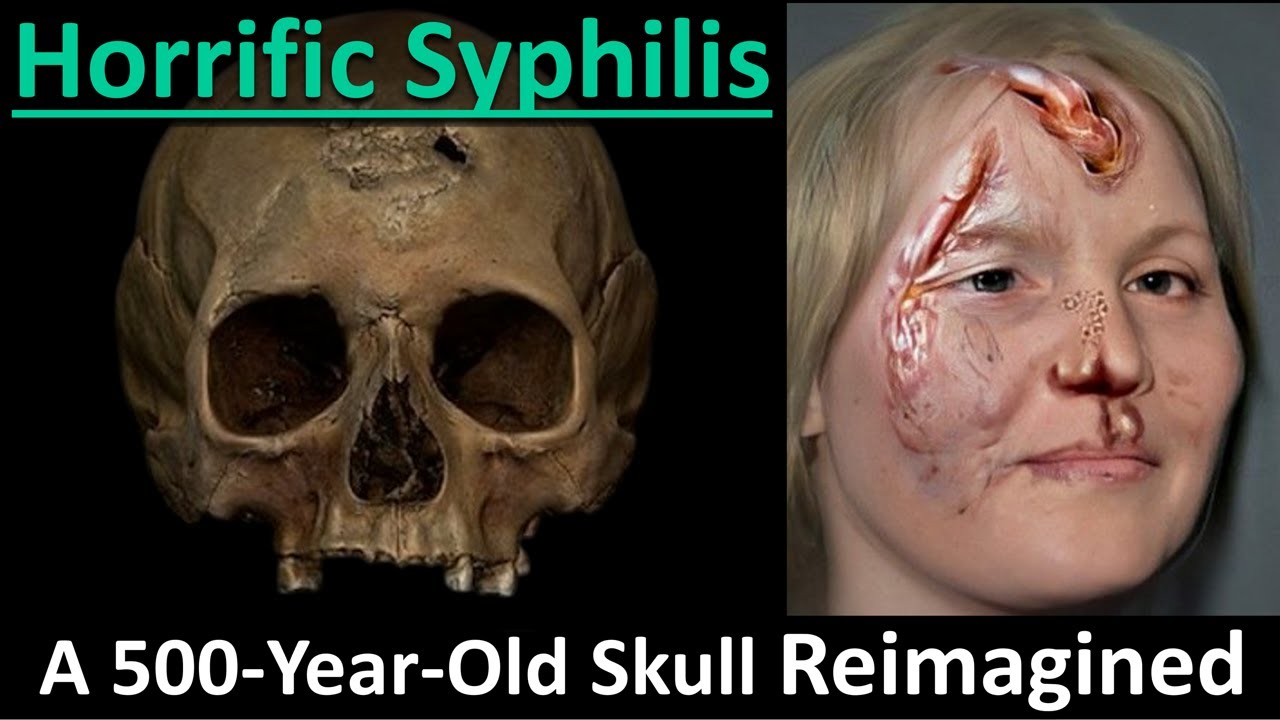See How Syphilis Destroyed a Woman & Her Skull 500 Years Ago- Recreated ...