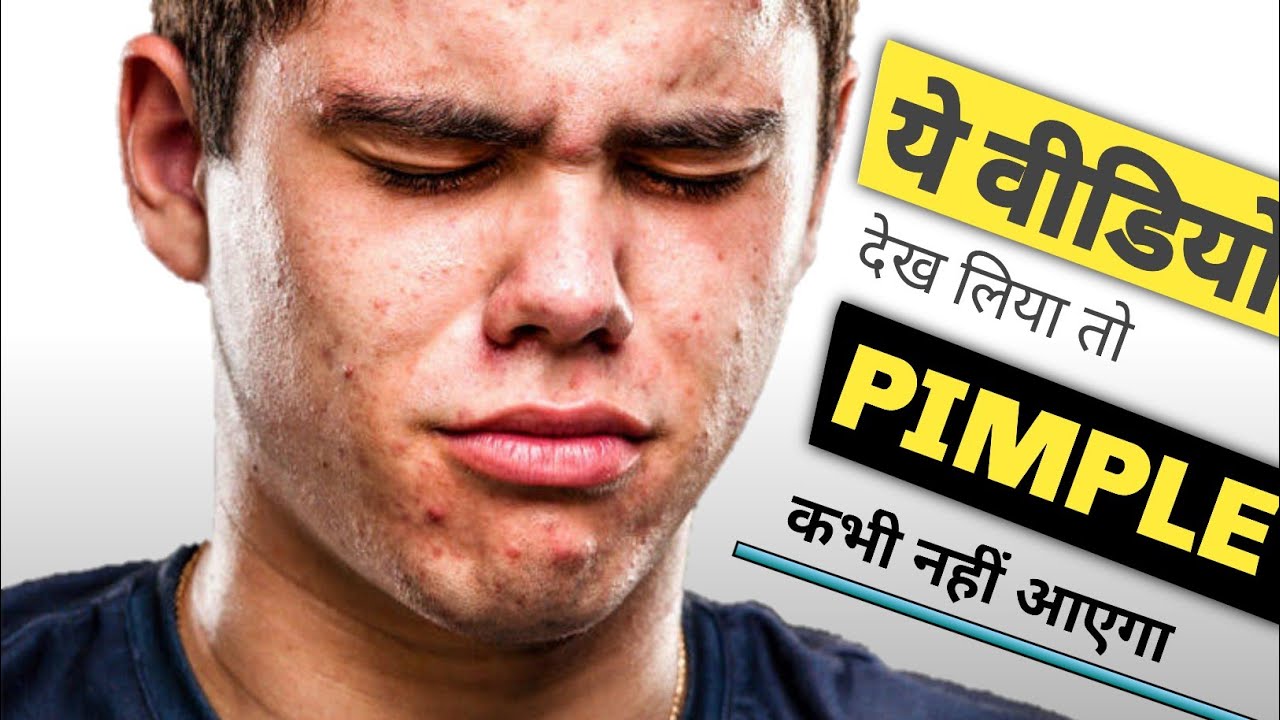 Permanent Solution For Pimples🔥 & Acne 🔥| हिंदी | Stop Pimple | Stop ...
