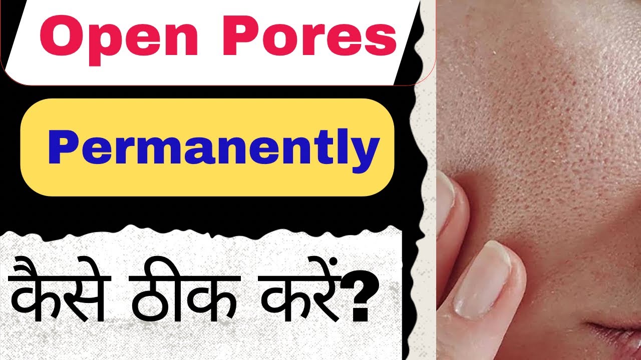 Open Pores Treatment || Acne Scars Treatment - YouTube