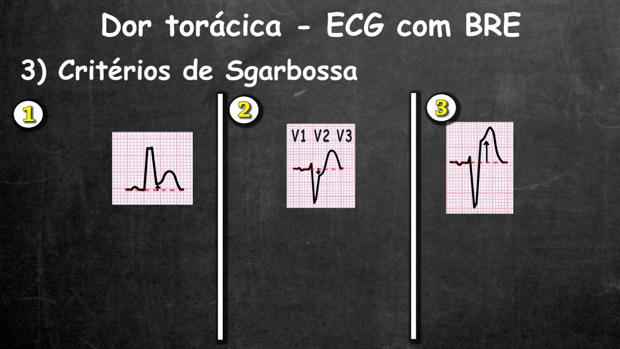 ECG com BRE na emergência - YouTube