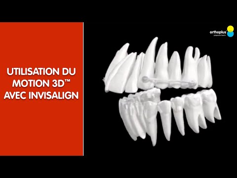 carriere motion avec invisalign - YouTube