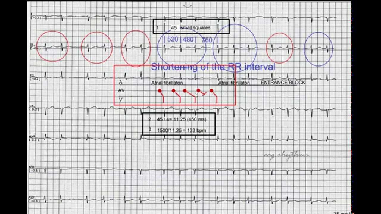 Regularized Atrial Fibrillation - YouTube