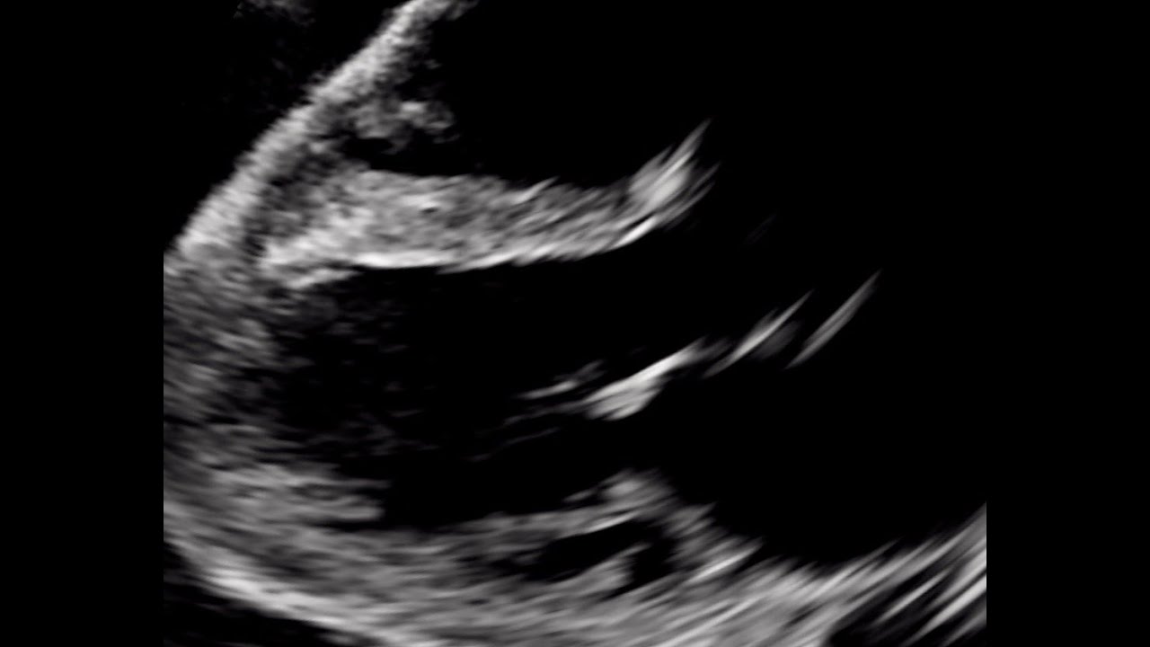 SHM POCUS Pearls: Where is the fluid - YouTube