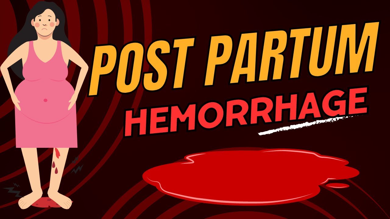 Post Partum Hemorrhage ( PPH) | Risk Factors, Causes and Management ...