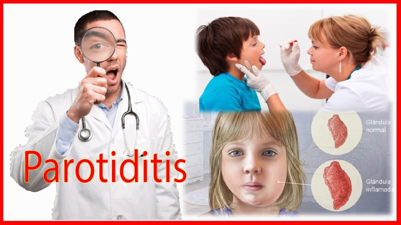 Parotiditis: Signos y sintomas, etiologia, diagnostico, cuadro clinico ...