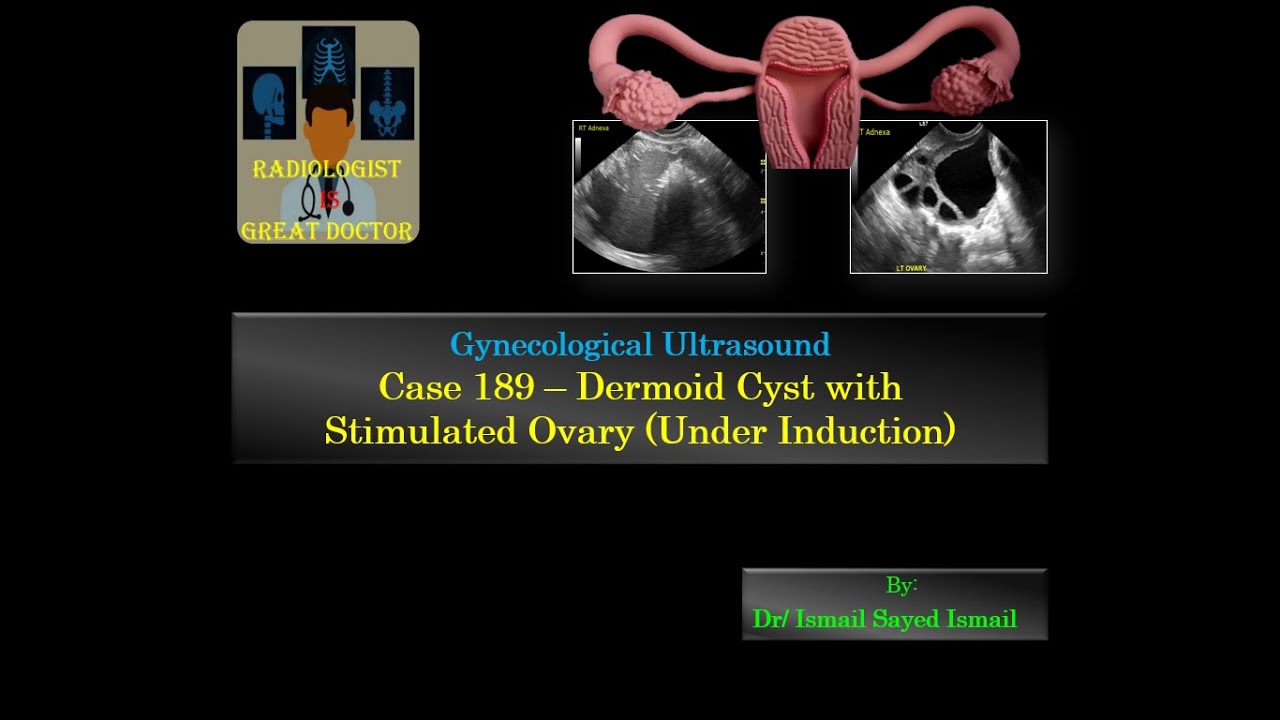 Ultrasound Case 189 - Dermoid Cyst with Stimulated Ovary - YouTube