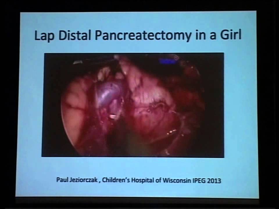 Technical considerations in Laparoscopic Subtotal Pancreatectomy - YouTube