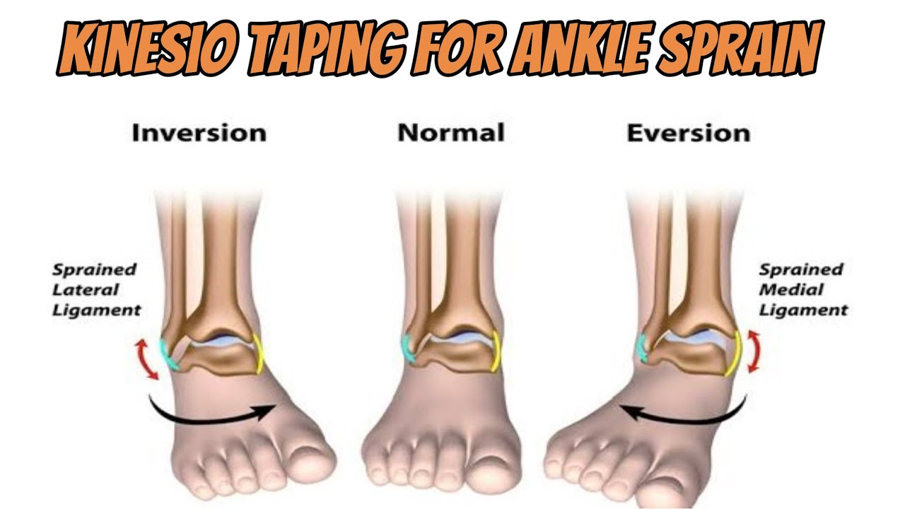 How To Do Kinesio Taping For Lateral Ankle Sprain | @PhysiofitByDrMajid ...