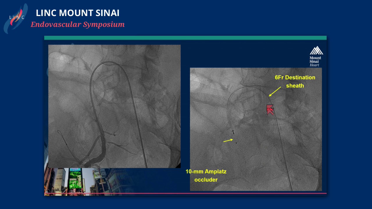 What Are The Risks of Internal Iliac Embolization and How Do We ...