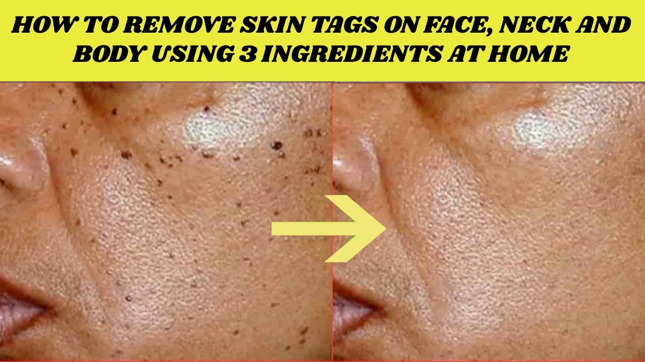 HOW TO QUICKLY + EASILY REMOVE SKIN TAGS AT HOME WITH JUST 3 ...