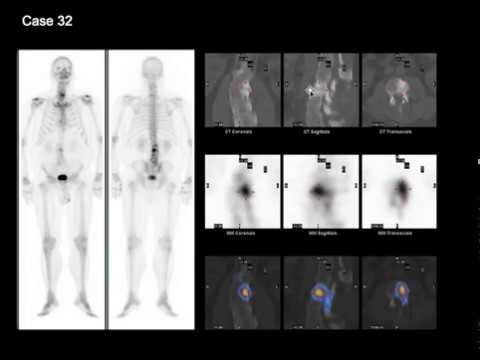 Whole Body Bone Scan Teaching File from Nuclear Medicine Handbook - YouTube