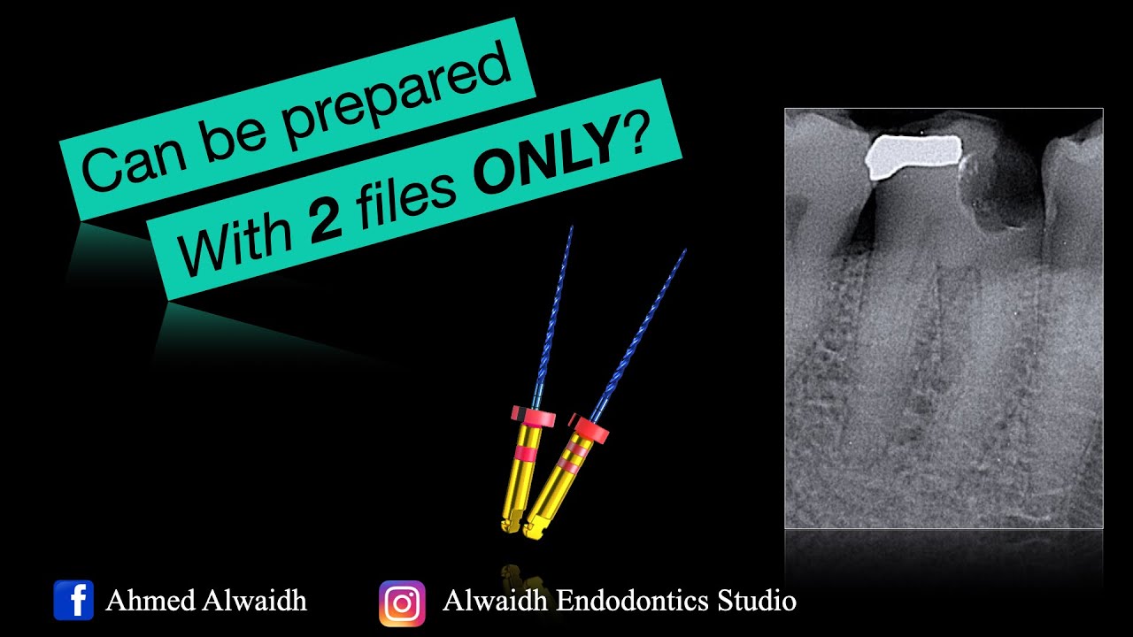 Can we prepare calcified lower molar with only 2 rotary files? - YouTube