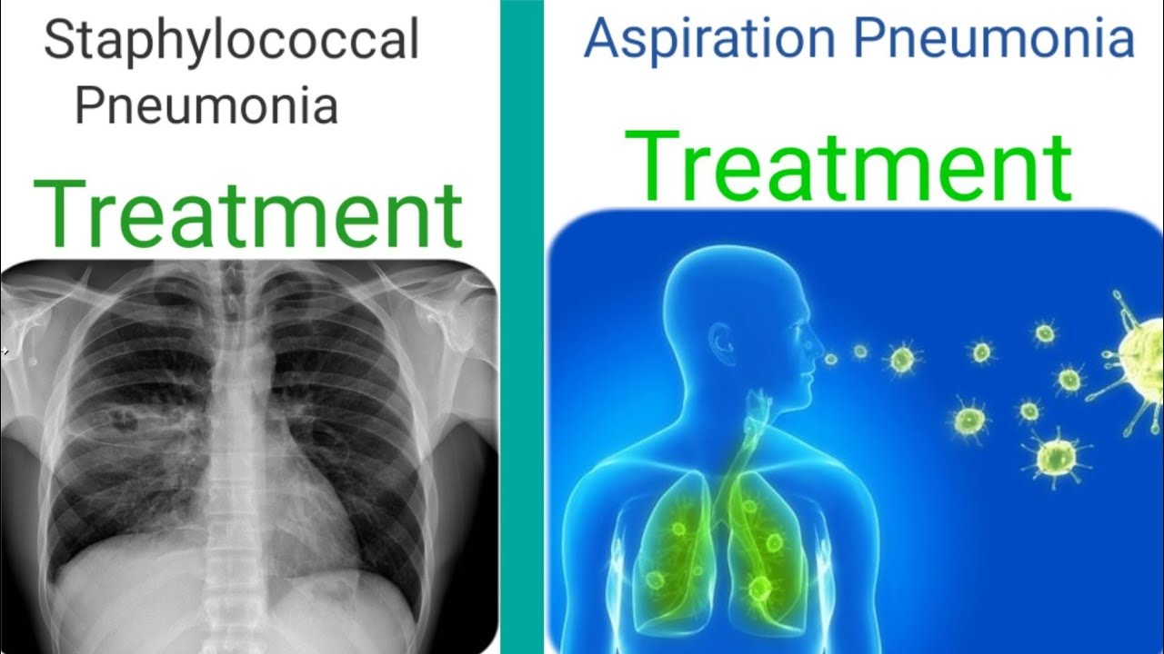 Staphylococcal & Aspiration Pneumonia Part-2 Treatment hinid ...