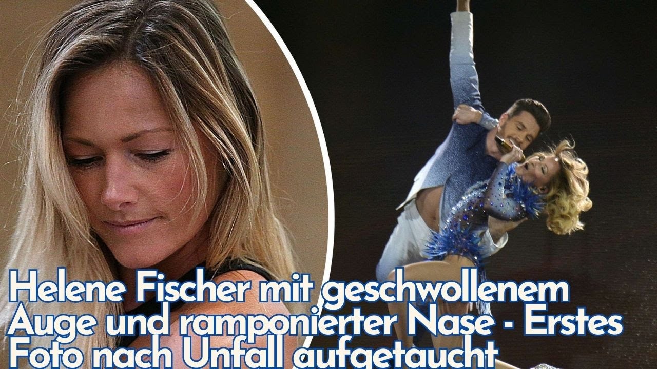 Helene Fischer mit geschwollenem Auge und ramponierter Nase Erstes Foto ...