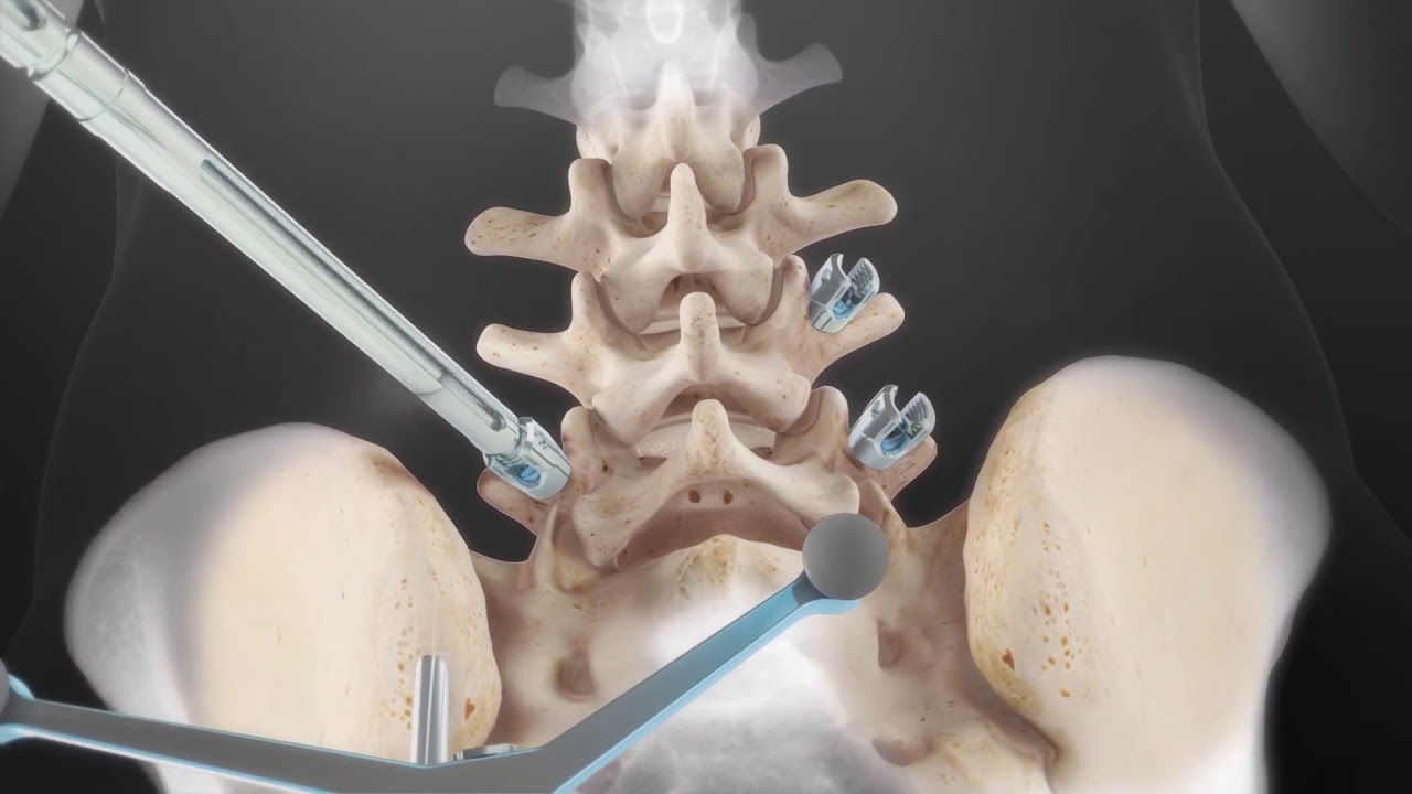 Medtronic | CD Horizon Solera: Tornillos ATS - YouTube