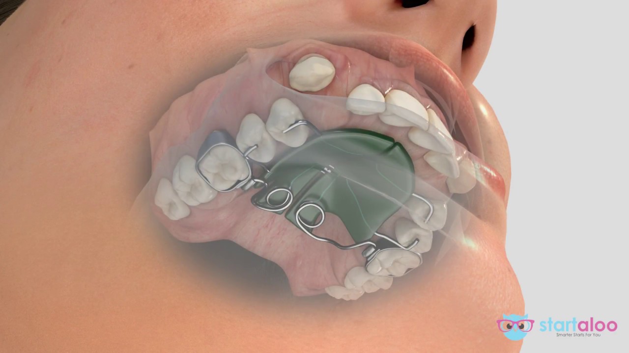 Distalizer Appliance - YouTube