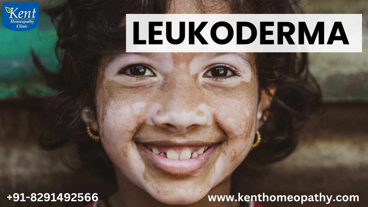 LEUKODERMA -Homeopathy Treatment Drkukreja kalani online consultation 8291492566 - YouTube