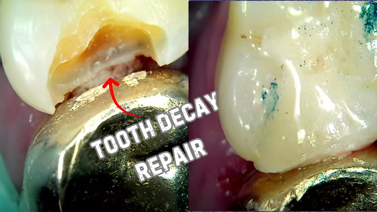 [49] Live Tooth Decay Repair Procedure (27MO) - YouTube
