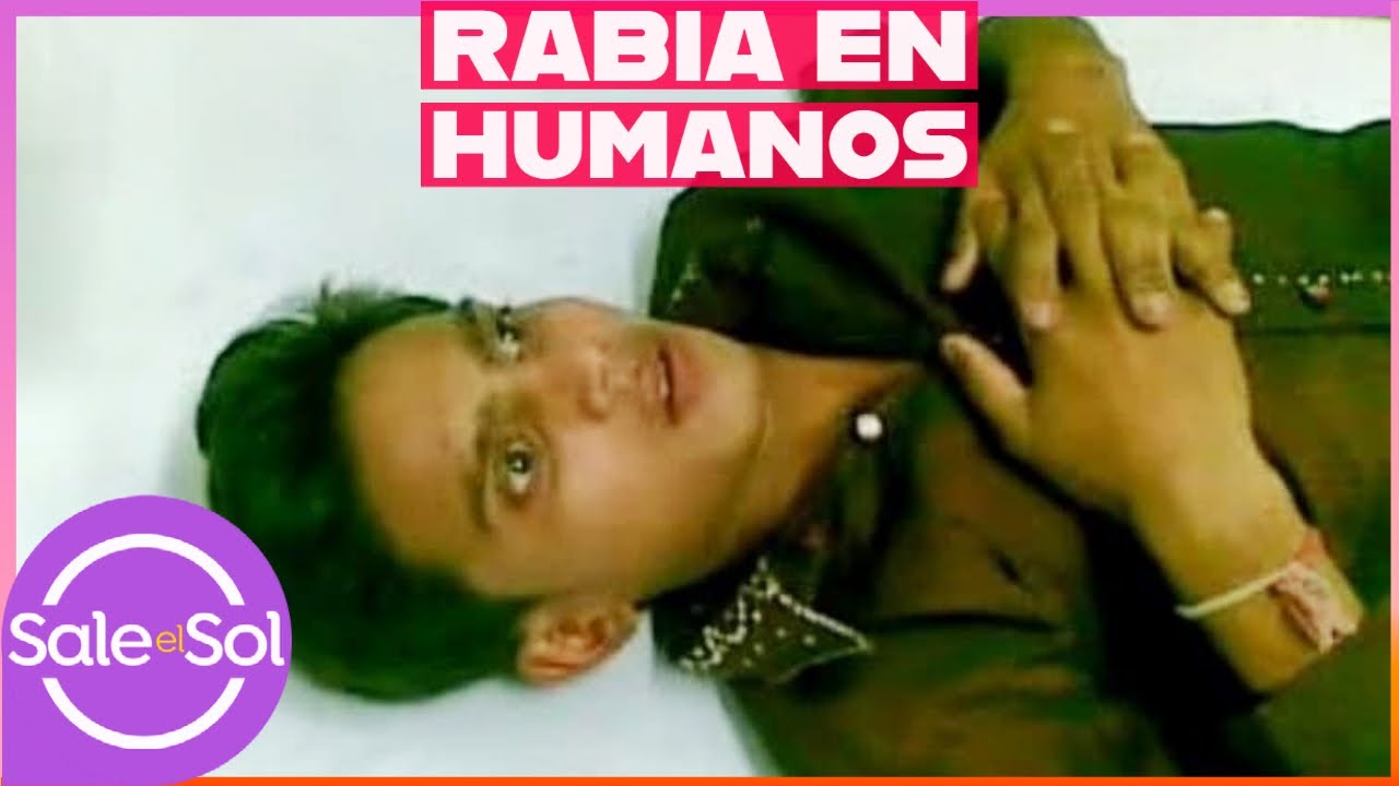 Dos casos confirmados de rabia en humanos, ¿cuáles son los síntomas ...