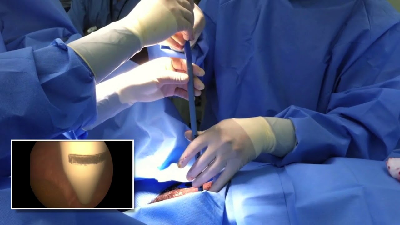 Bladder Stones - Percutaneous cystolithotomy - YouTube