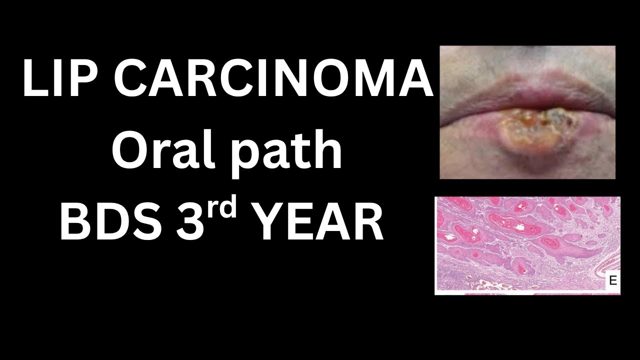 Lip Carcinoma (oral pathology topic) BDS 3rd year - YouTube